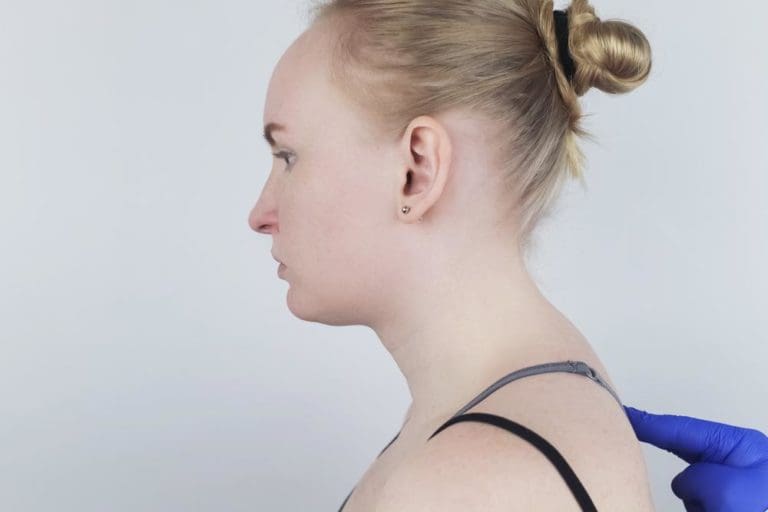 Treating Dowager's Hump - Chiropractic Care for Neck Humps